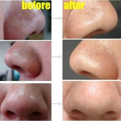 How To Get Rid Of Nose Blackheads In Men Macho Vibes